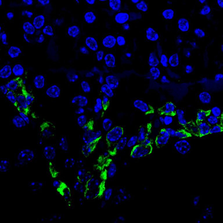 What are beta cell therapies, and do they offer hope for a cure for ...